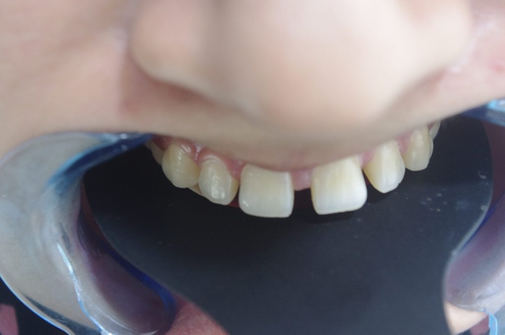 Bioclear Matrix Composite Veneers & Gap Closing in Lahore